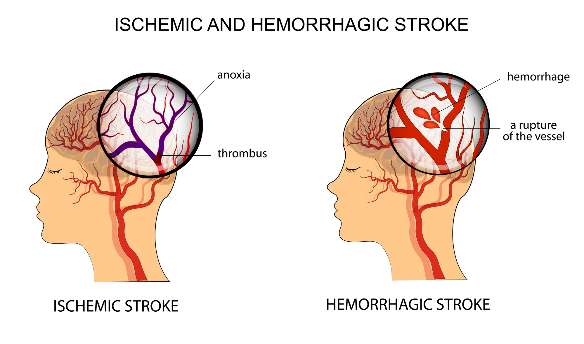 Stroke Prevention Idaho Falls Community Hospital